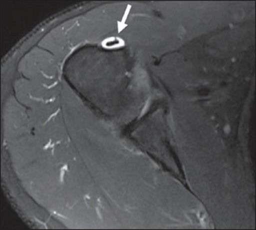 Long head of the biceps brachii tendon: unenhanced MRI versus direct MR ...