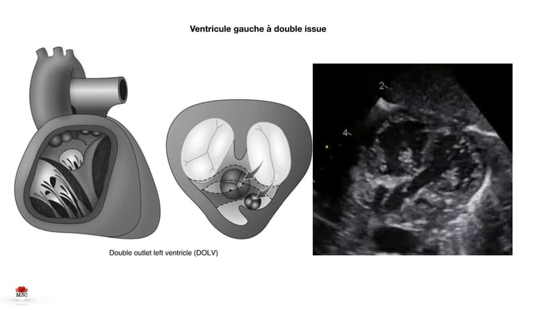 Centre de Référence M3C Malformations Cardiaques Congénitales Complexes