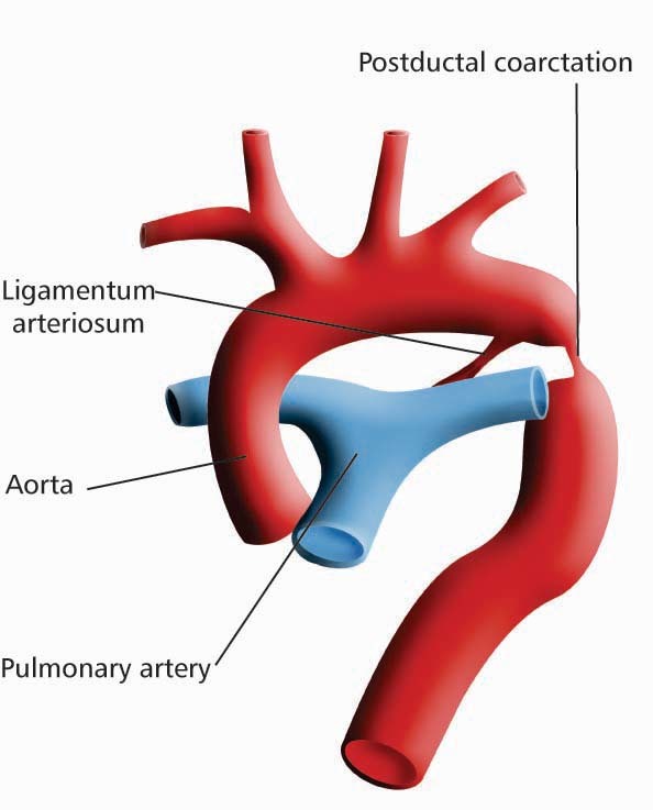 La coarctation de l'Aorte - CARPEDEM-M3C