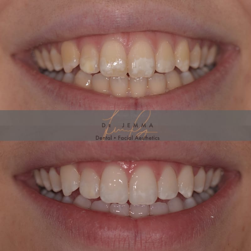 ICON White Spot Removal - Aesthetics by Dr Jemma Ltd