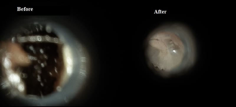 ear wax removal, microsuction by hearing health practitioner