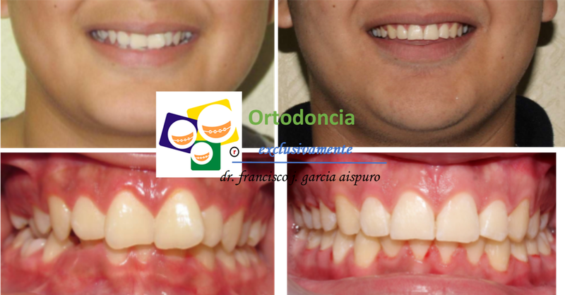 Corrección de mordidas profundas - OrtoAispuro Dental
