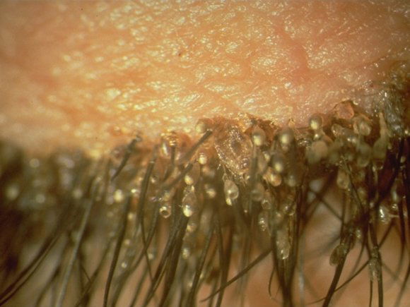 SEVERE PEDICULOSIS bLEPHARITIS - eyedr4kids