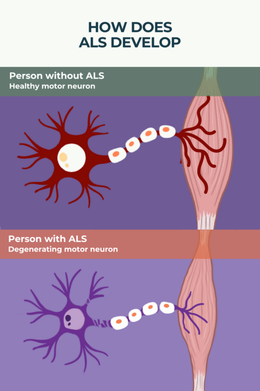 8 Things You Must Know About ALS: Understanding Amyotrophic Lateral ...