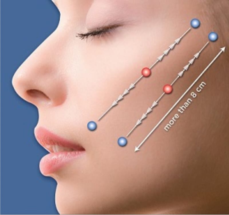 PDO sutures and Thread Lift Procedures - Elìd Medical Aesthetics
