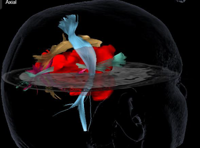 Preoperative DTI - Oxford Brain Tumour Team