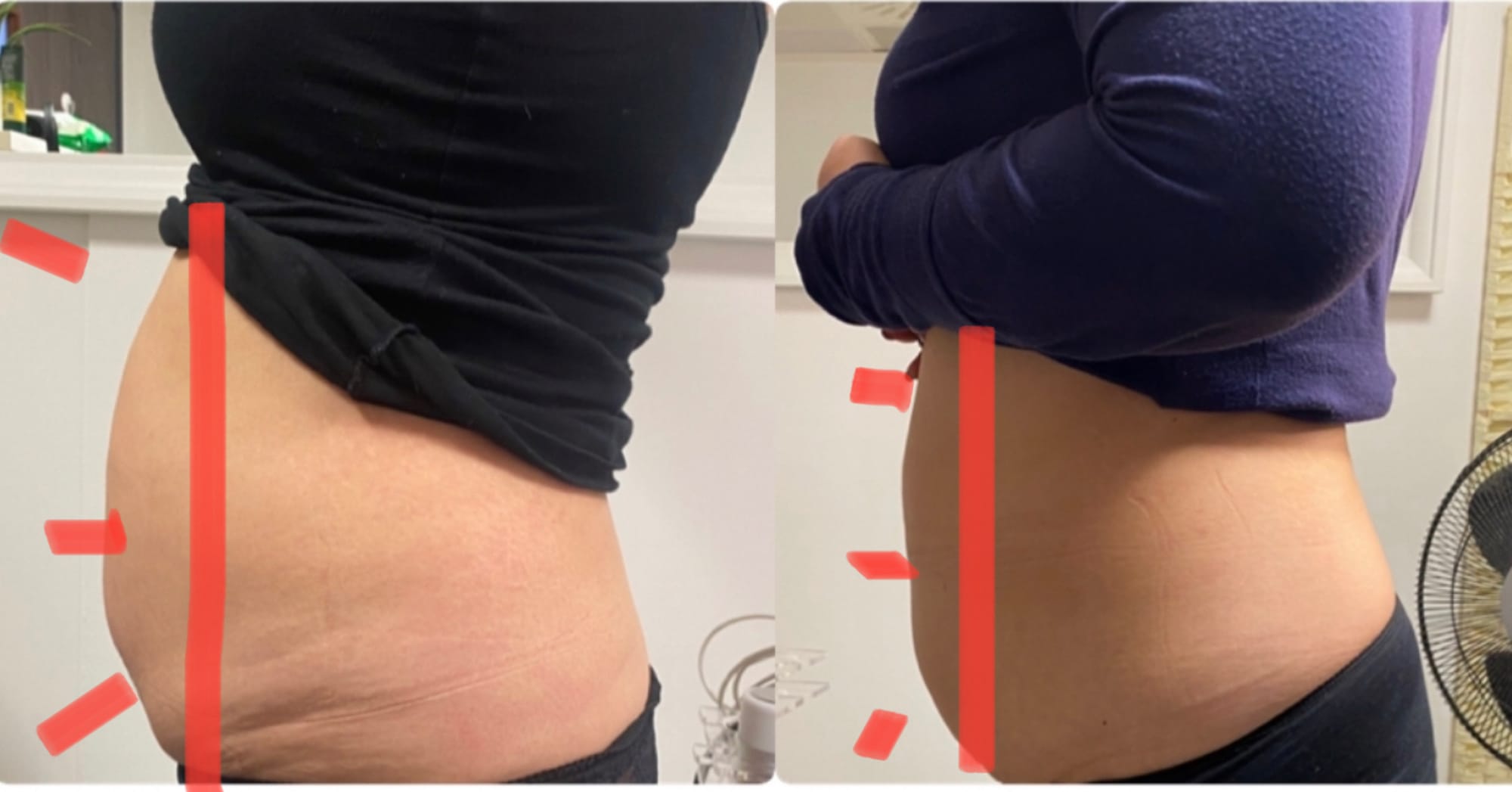 Practitioners of Laser & RF Lipo, Fat Cell Destruction in Birmingham