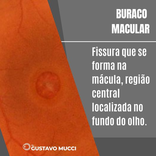 Buraco Macular - Dr.Gustavo Mucci - Oftalmologista