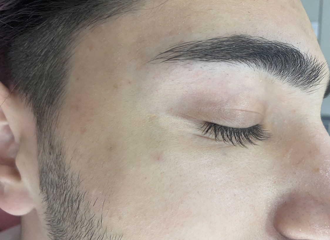 Ameliyat izi Meme estetiği Meme Kanseri Vitiligo Çatlak Tedavisi