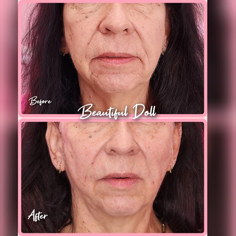 Beauty, Botox, Pdo threads, iv therapy, fillers, prp, aesthetics