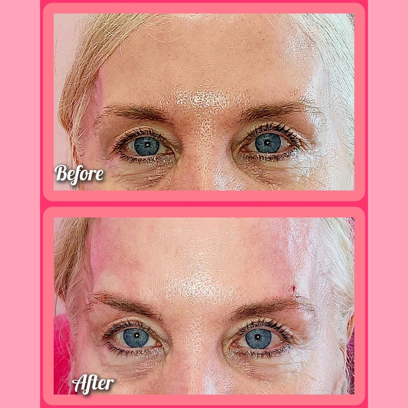 Beauty, Botox, Pdo threads, iv therapy, fillers, prp, aesthetics