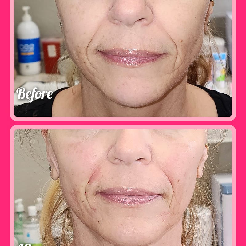 Beauty, Botox, Pdo threads, iv therapy, fillers, prp, aesthetics