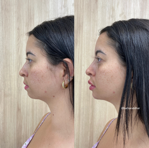 Preenchimento Facial - Bárbara Bilhar Estética Avançada
